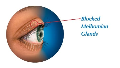 Meibomian gland dysfunction - The Eye Practice