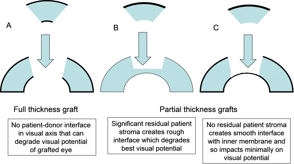 Corneal transplant - The Eye Practice