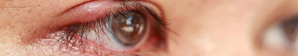 Blepharitis - The Eye Practice