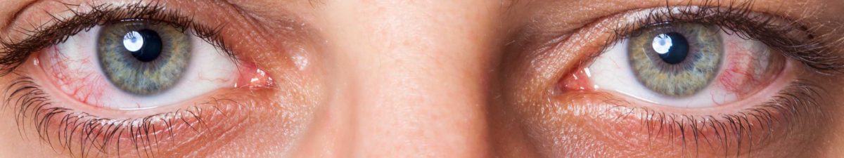 Conjunctivitis - The Eye Practice