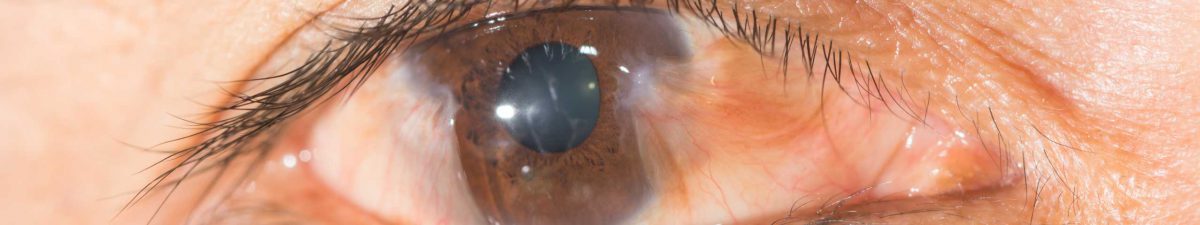 Pinguecula - The Eye Practice