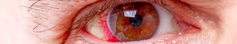 Diseases and Disorders of the Choroid - The Eye Practice