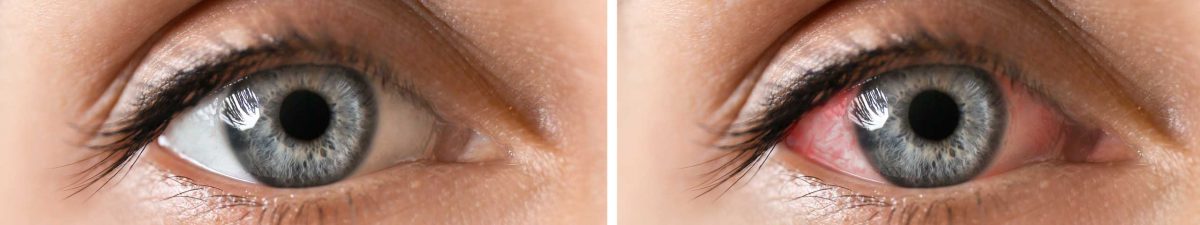 Uveitis (Iritis) - The Eye Practice