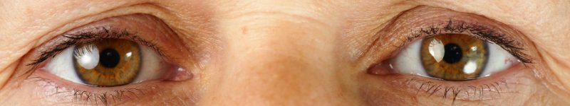 BlephEx - The Eye Practice