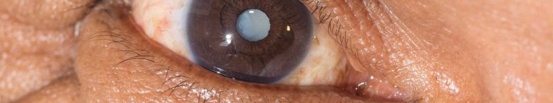 Cataract eye test - The Eye Practice