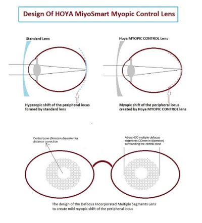 Latest update: how to best control your child's myopia - The Eye Practice